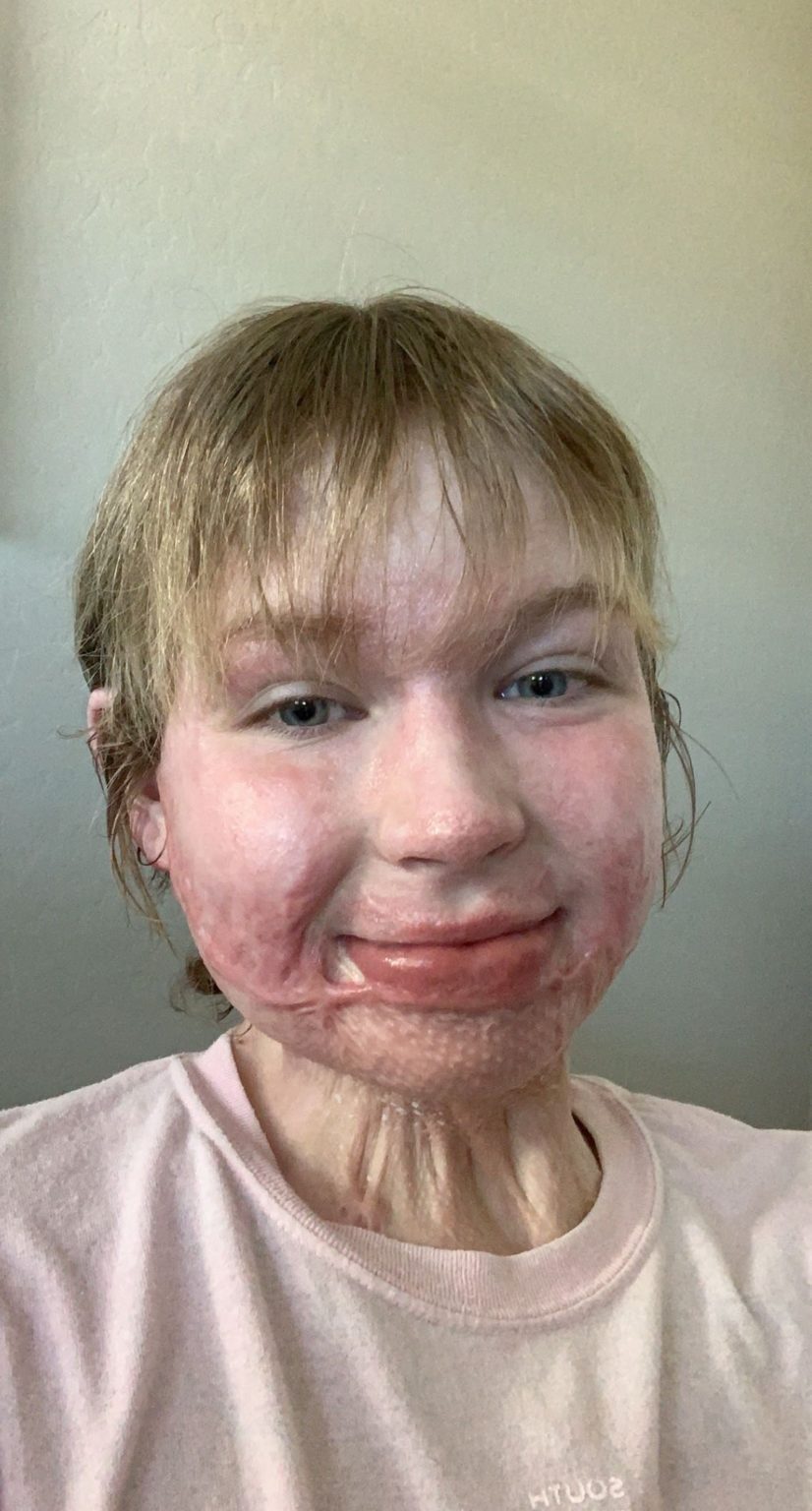 Claire - Arizona Burn Foundation